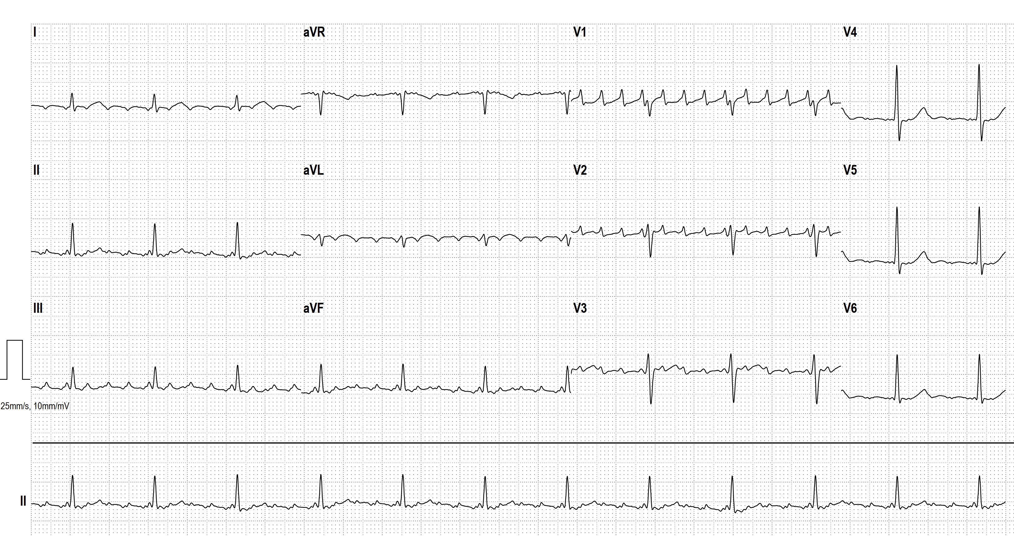 Atrial Flutter Ecg Guru Instructor Resources
